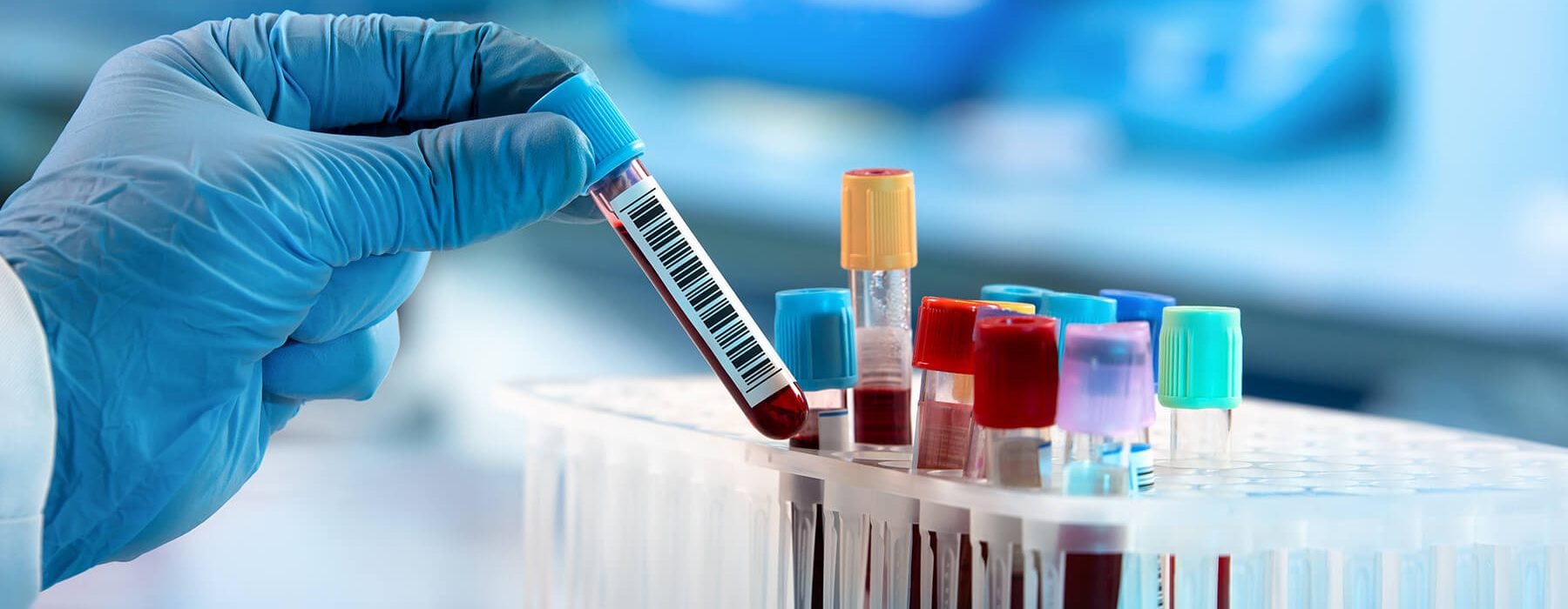 Test serológicos para combatir el coronavirus: ¿cómo funcionan?